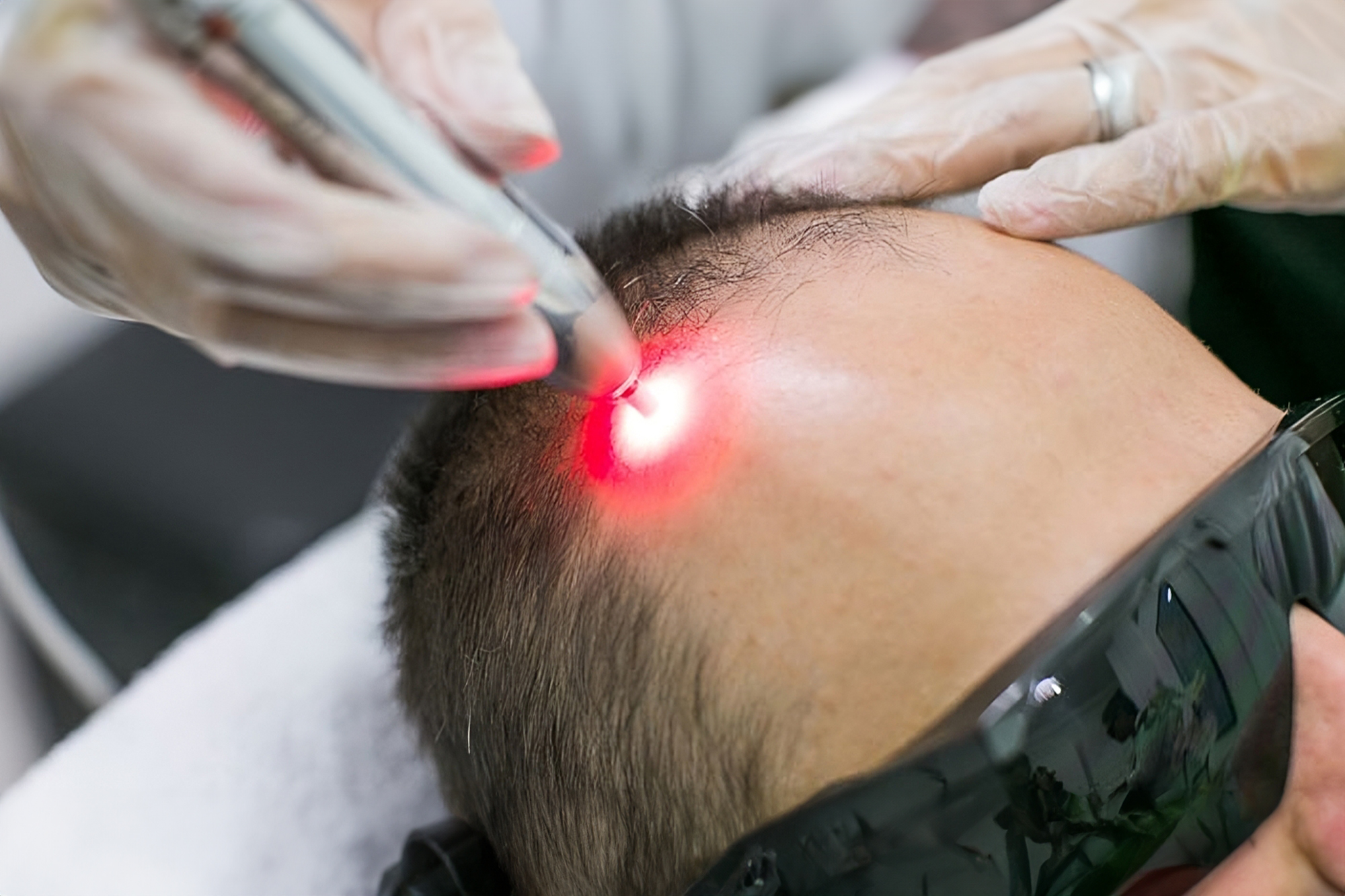 Laser Hair Therapy - Tricologista Rodrigo